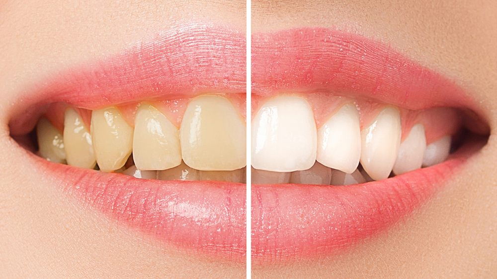 The Top 9 Foods That Are Staining Your Teeth - EVERBELLA